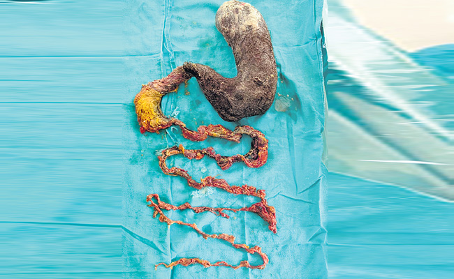 Shocking: Doctors Remove Huge Hairball From Teen Stomach Goes Viral ...