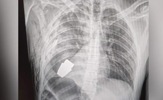 Ukraine Army Doctor Removed Live Grenade From Soldier Chest, Saved His ...