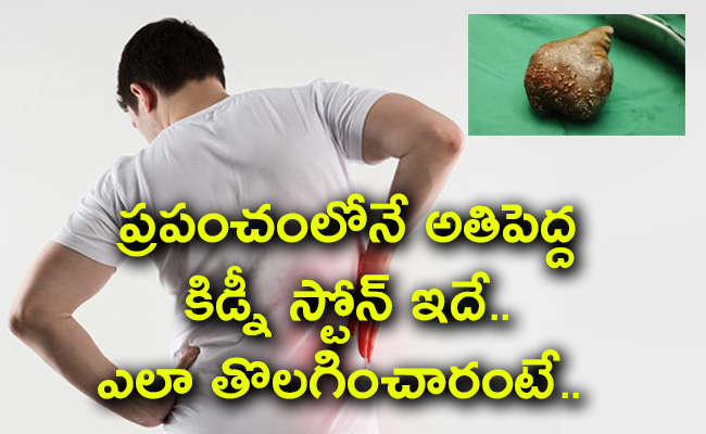 World's Largest Kidney Stone Removed, To Know Precautionary Tips - Sakshi