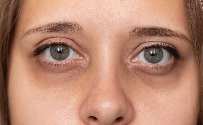 Best Home Remedies And Natural Tips On How To Lighten Dark Elbows And ...