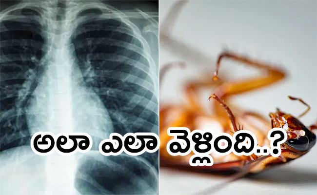 ఊపిరితిత్తుల్లో బొద్దింక..కంగుతిన్న వైద్యులు! | Kerala Doctors Remove ...